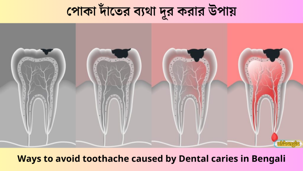 পোকা দাঁতের ব্যথা দূর করার উপায়, Details of Dental caries in Bangla