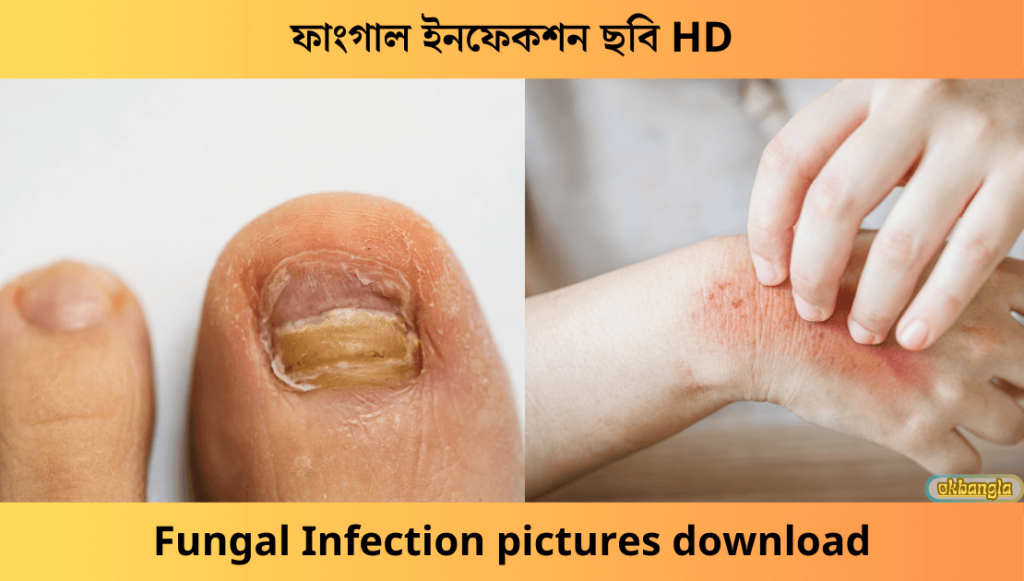 275+ফাংগাল ইনফেকশন ছবি , Fungal Infection pictures download